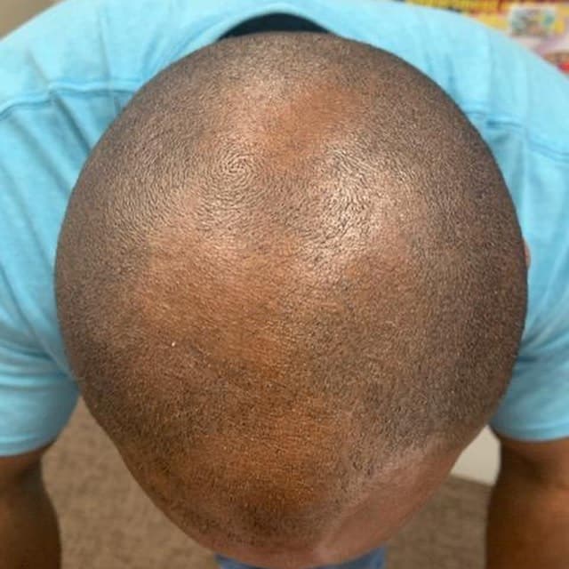 Elevate Your Appearance with Scalp Micropigmentation in Atlanta, GA